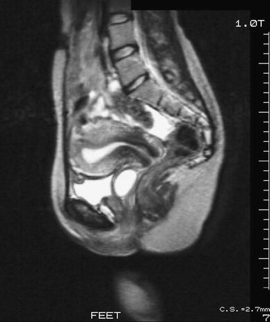 Multiple vaginal mullerian cysts: a case report and review of ...