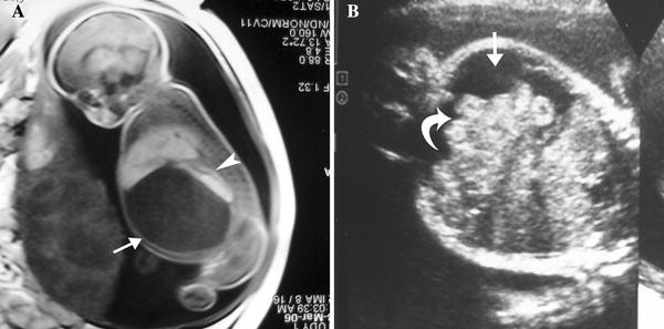 Role of MRI in fetal abdominal cystic masses detected on prenatal ...