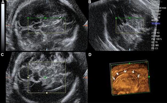 Development of fetal brain sulci and gyri: assessment through two and ...
