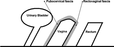 Laparoscopic management of genital prolapse | SpringerLink