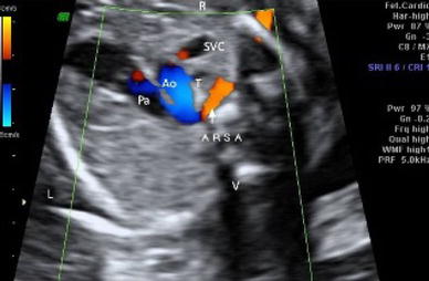 Associated anomalies and outcome of fetal aberrant right subclavian ...