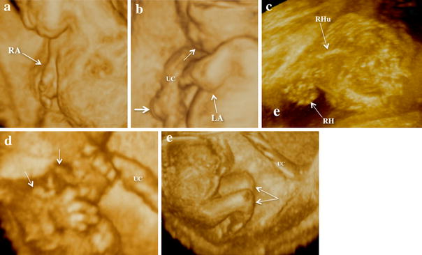 Antenatal three-dimensional sonographic features of Roberts syndrome ...