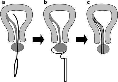 Endoloop ligation technique for prolapsed pedunculated submucous ...