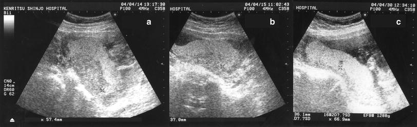 The role of asymmetric thickening of the uterine myometrium during ...