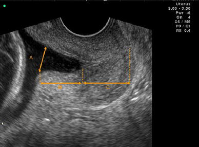 Short cervix syndrome: current knowledge from etiology to the control ...