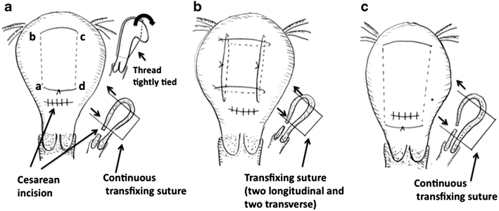 Is it time to classify various uterine compression suture techniques ...