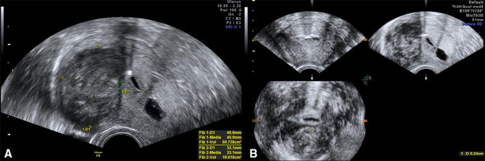 Hysterosalpingo contrast sonography (HyCoSy): let’s make the point ...