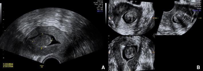 Hysterosalpingo contrast sonography (HyCoSy): let’s make the point ...