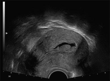 Hysterosalpingo contrast sonography (HyCoSy): let’s make the point ...
