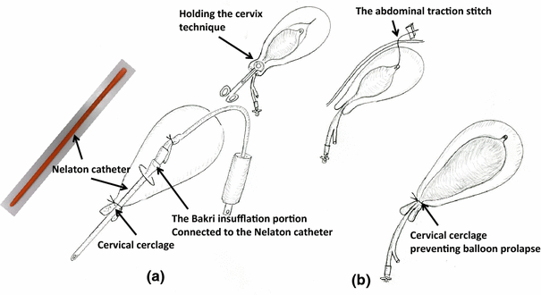 Inserting and holding the Bakri balloon in the uterus in a patient with ...