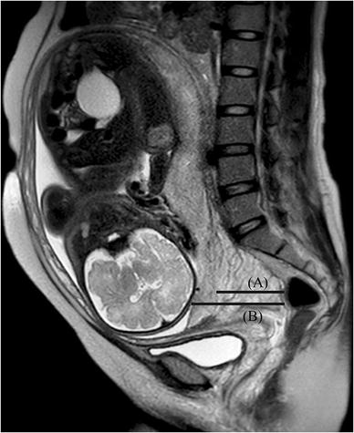 Cervical varicosities may predict placenta accreta in posterior ...