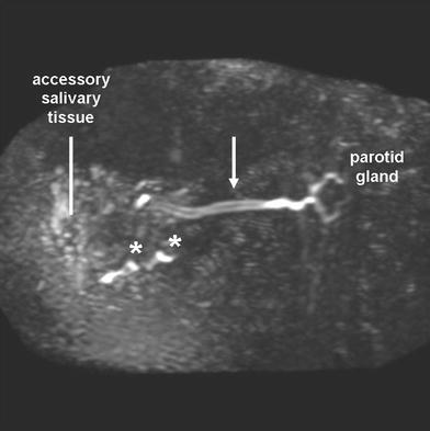 Accessory parotid gland lesions: case report and review of literature ...