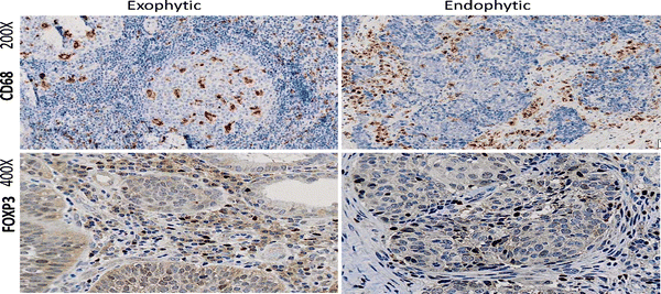 Head and neck squamous carcinomas with exophytic and endophytic type of ...