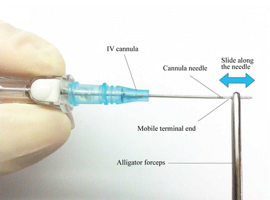 A novel technique of otic barotrauma management using modified ...