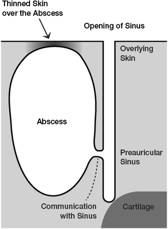 Early one-stage surgical treatment of infected preauricular sinus ...