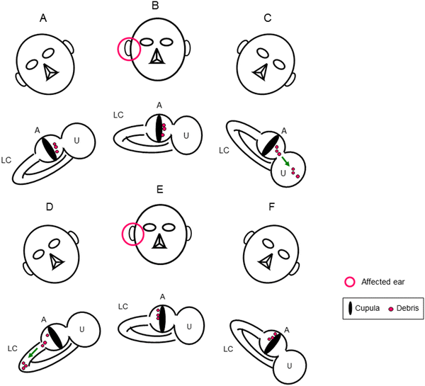 New treatment strategy for cupulolithiasis associated with benign ...
