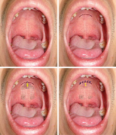 A novel palatal implant surgery combined with uvulopalatopharyngoplasty ...