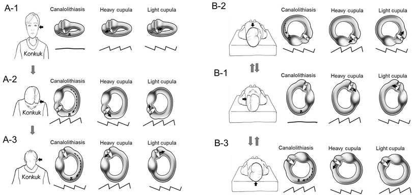Lateralization of horizontal semicircular canal canalolithiasis and ...