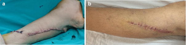 Medial sural artery perforator flap in head and neck reconstruction ...