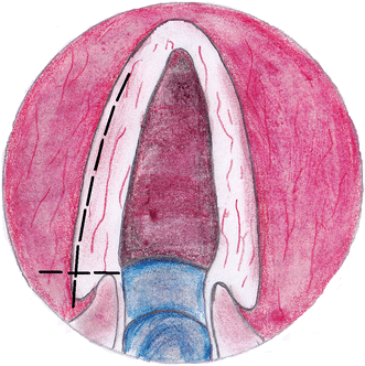 Comparison of long-term voice outcomes after vocal fold augmentation ...