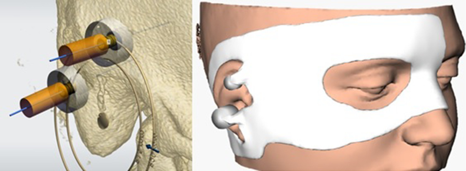 Auricular prostheses attached to osseointegrated implants ...