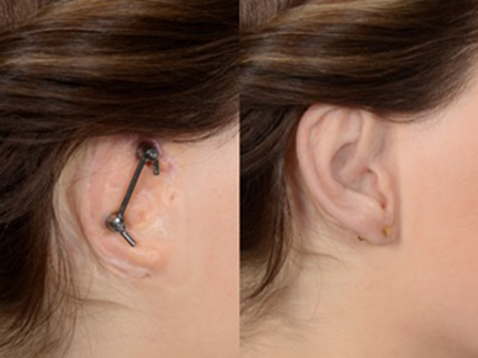 Auricular prostheses attached to osseointegrated implants ...