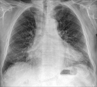 Diffuse Lung Disease in Neurofibromatosis | SpringerLink