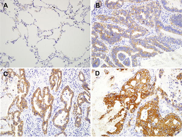 IMP3 Predicts Invasion and Prognosis in Human Lung Adenocarcinoma ...