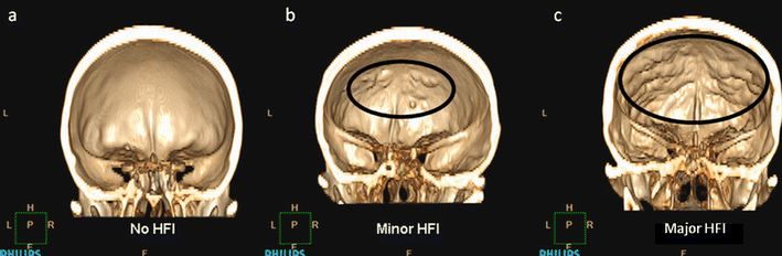 Hyperostosis frontalis interna: criteria for sexing and aging a ...