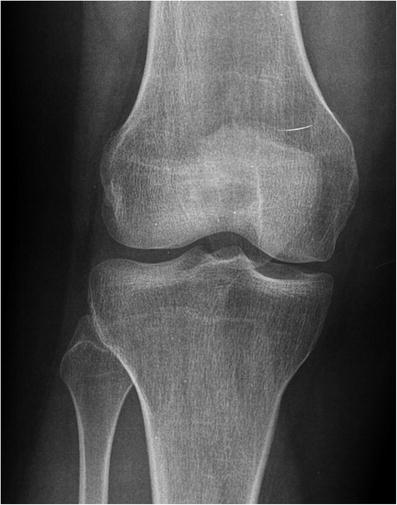 Radiographic analysis of epiphyseal fusion at knee joint to assess ...