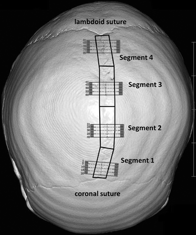 Age estimation by multidetector CT images of the sagittal suture ...