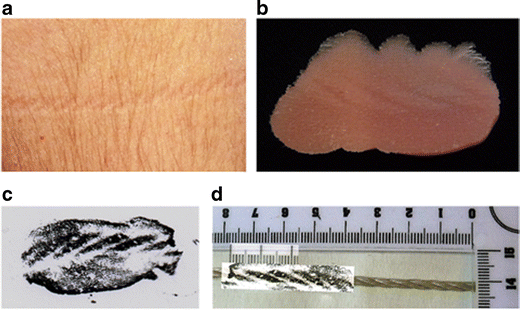 The persistence of ligature marks: towards a new protocol for victims ...