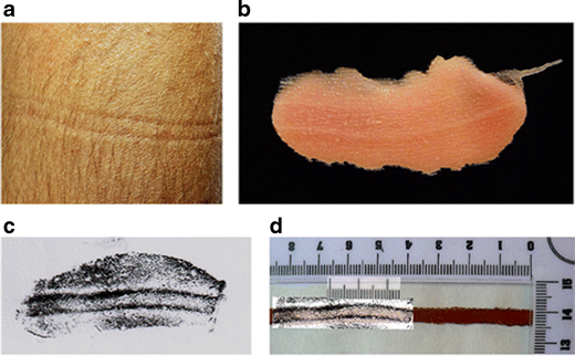 The persistence of ligature marks: towards a new protocol for victims ...