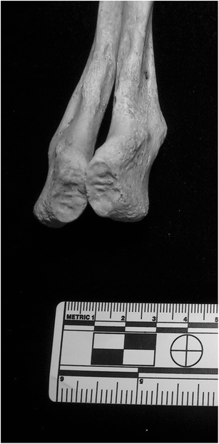 The lateral clavicular epiphysis: fusion timing and age estimation ...