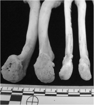The lateral clavicular epiphysis: fusion timing and age estimation ...