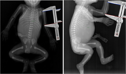 A method for estimating gestational age of fetal remains based on long ...