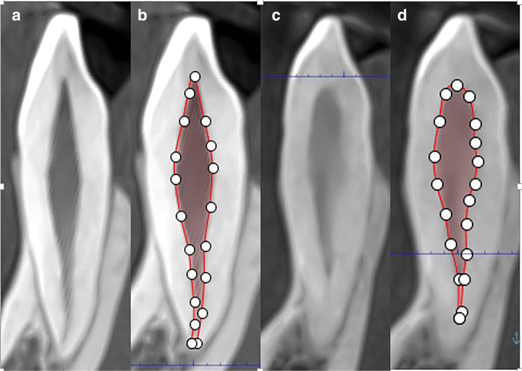 Age estimation using canine pulp volumes in adults: a CBCT image analysis | SpringerLink