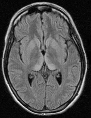 The first case of variant Creutzfeldt-Jakob disease in the Netherlands ...