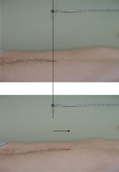 Beevor’s sign in facioscapulohumeral muscular dystrophy: an old sign ...