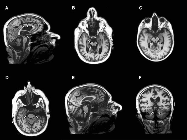 Magnetic resonance imaging in progressive supranuclear palsy | SpringerLink