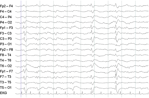 Posterior reversible encephalopathy syndrome (PRES ...