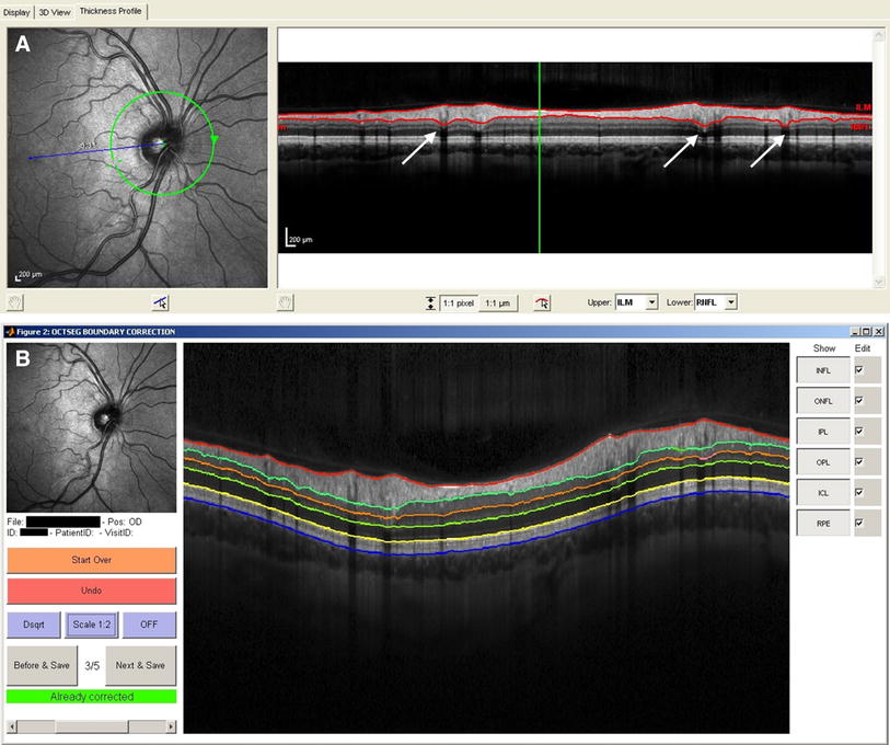 Retinal hyperaemia-related blood vessel artifacts are relevant to ...