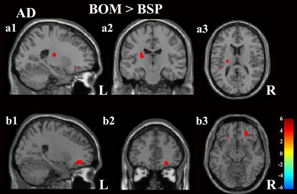 Diffusion tensor imaging in blepharospasm and blepharospasm ...