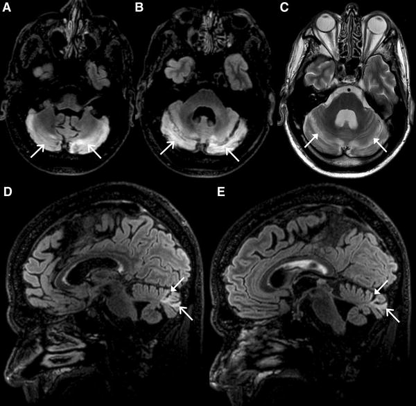 Heterogeneous imaging characteristics of JC virus granule cell ...