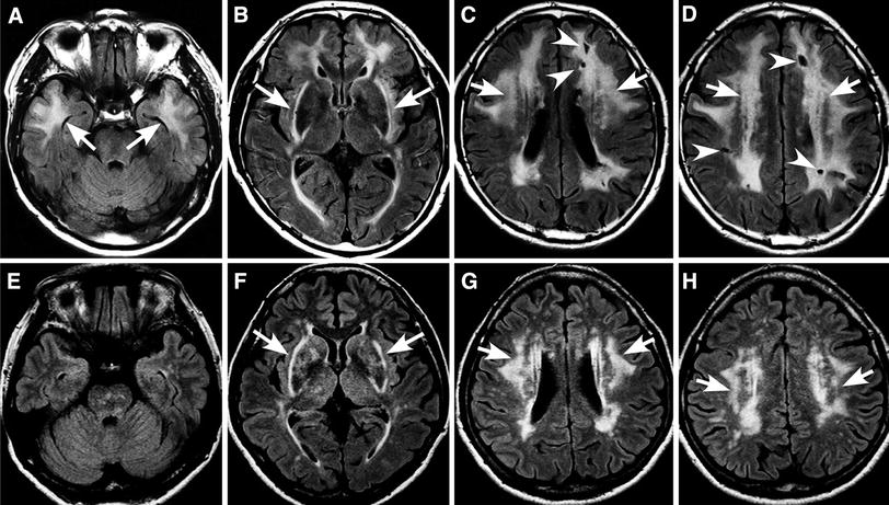 Genotypic and phenotypic spectrum of CADASIL in Japan: the experience ...