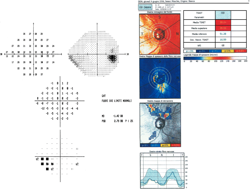 GDx-VCC performance in discriminating normal from glaucomatous eyes ...