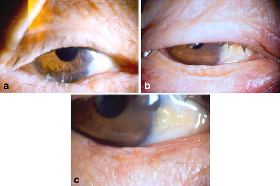 Eyelid splitting with follicular extirpation using a monopolar cautery ...