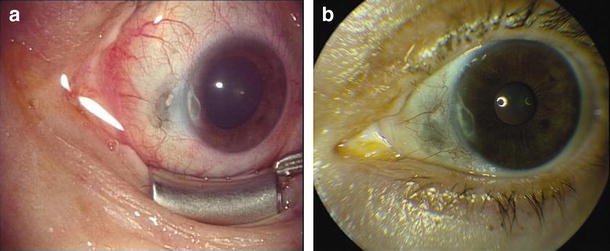Autogenous lamellar scleral graft in the treatment of scleral melt ...