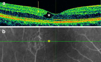 Macular cysts, holes and cavitations | SpringerLink