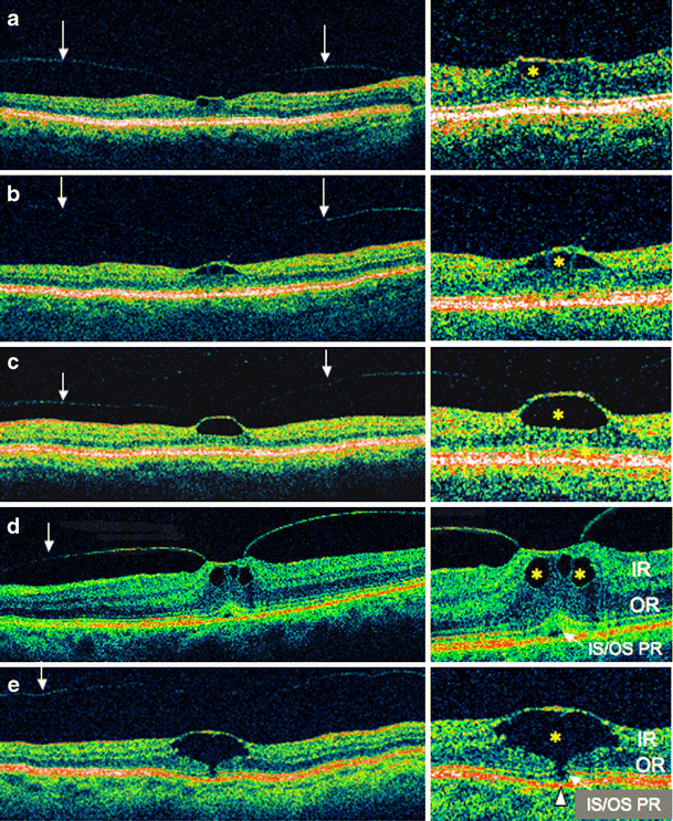 Macular cysts, holes and cavitations | SpringerLink